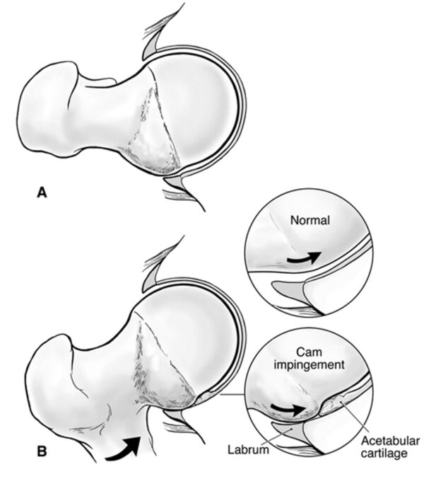 Understanding Hip Joint Pain in the Young Adult - The Science PT